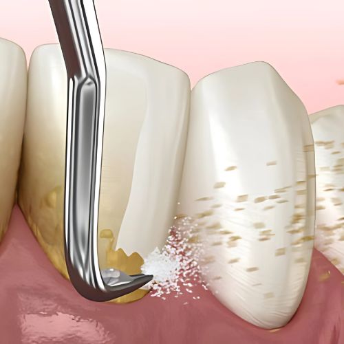 Détartrage et surfaçage radiculaire au cabinet dentaire Cavalaire